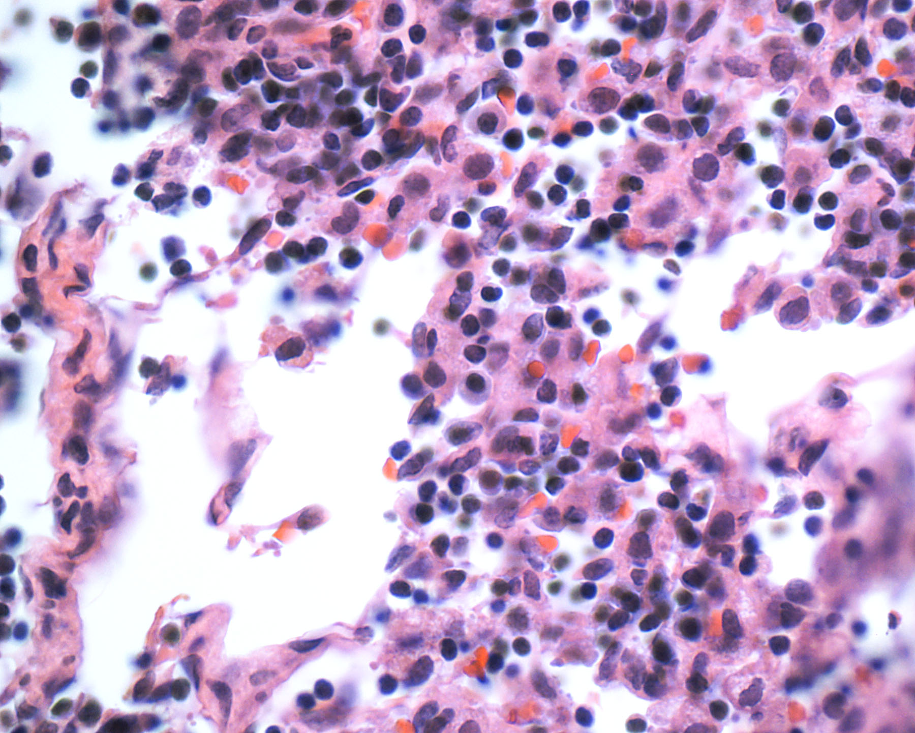 Fig. 3.15a Non-Neoplastic: Lymphoepithelial Cyst | University of ...