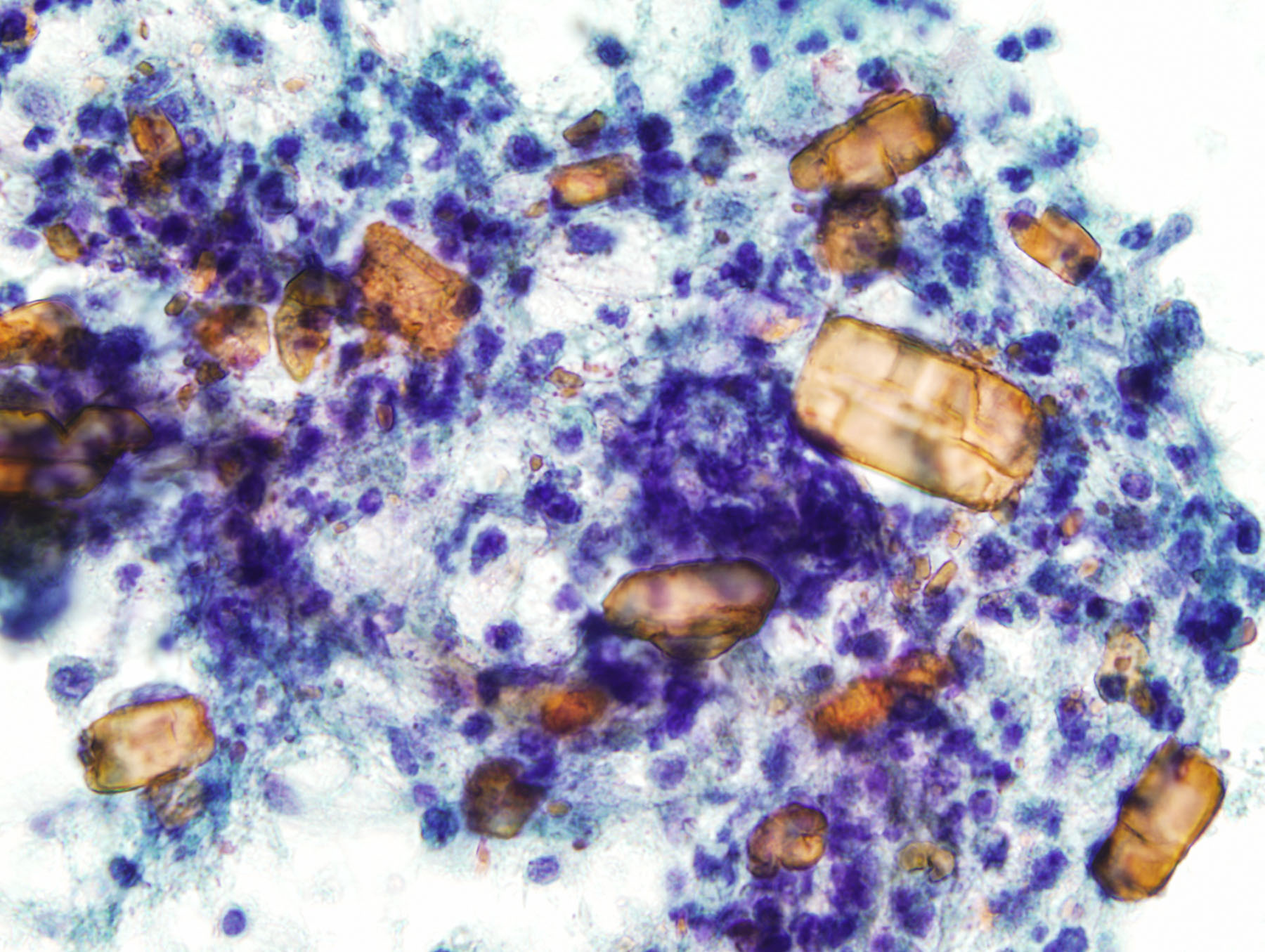Fig. 3.8b Non-Neoplastic: Chronic Sialadenitis with Amylase Crystals ...