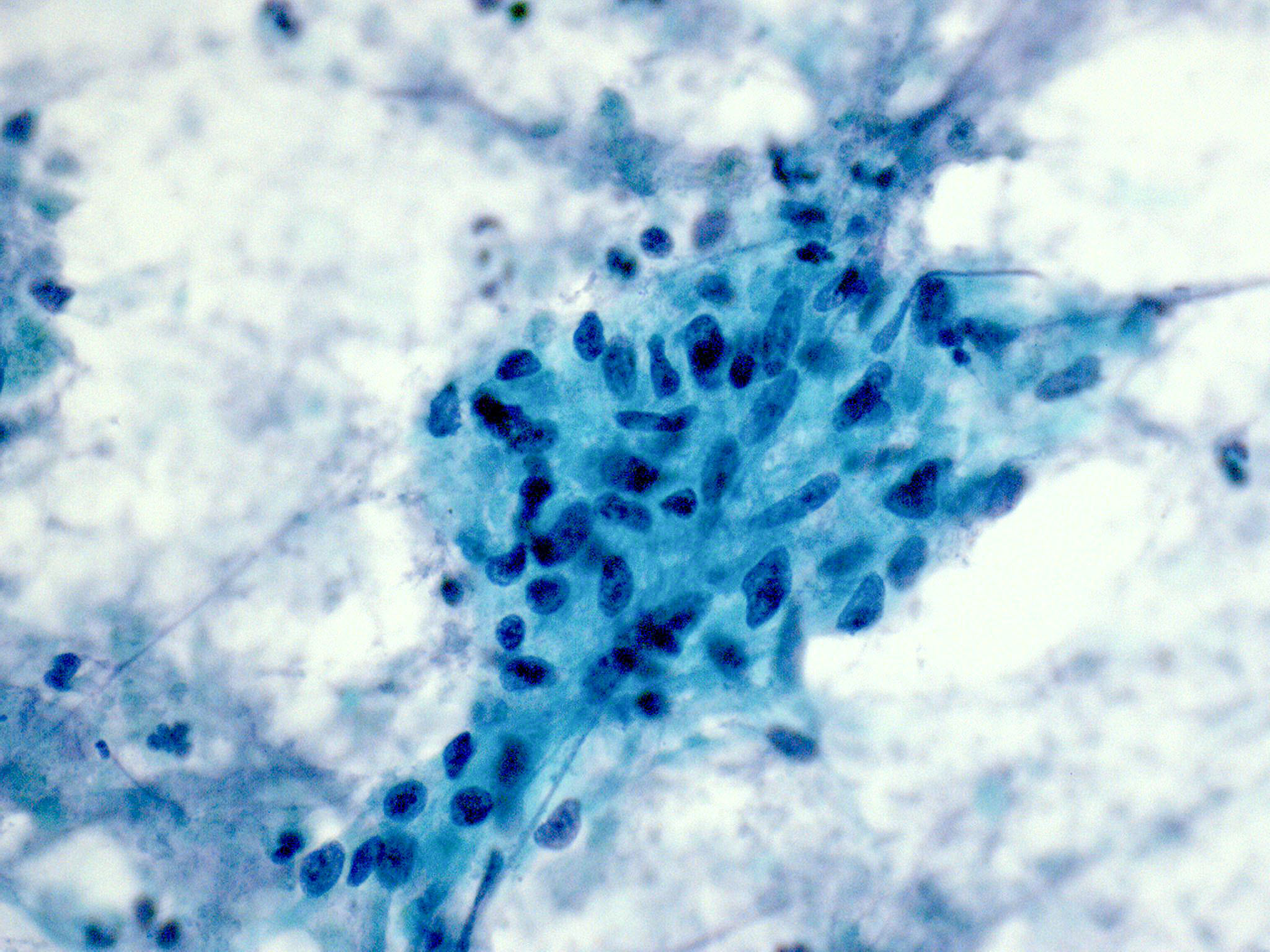 Fig. 3.9b Non-Neoplastic: Granulomatous Sialadenitis | University of ...