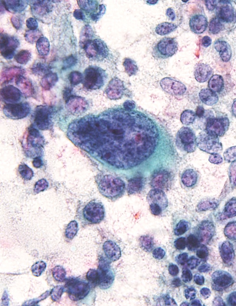 Fig. 4.1a Atypia of Undetermined Significance (AUS) | University of ...