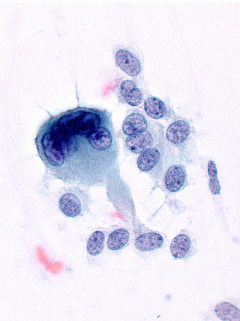 Fig. 4.1b Atypia of Undetermined Significance (AUS) | University of ...