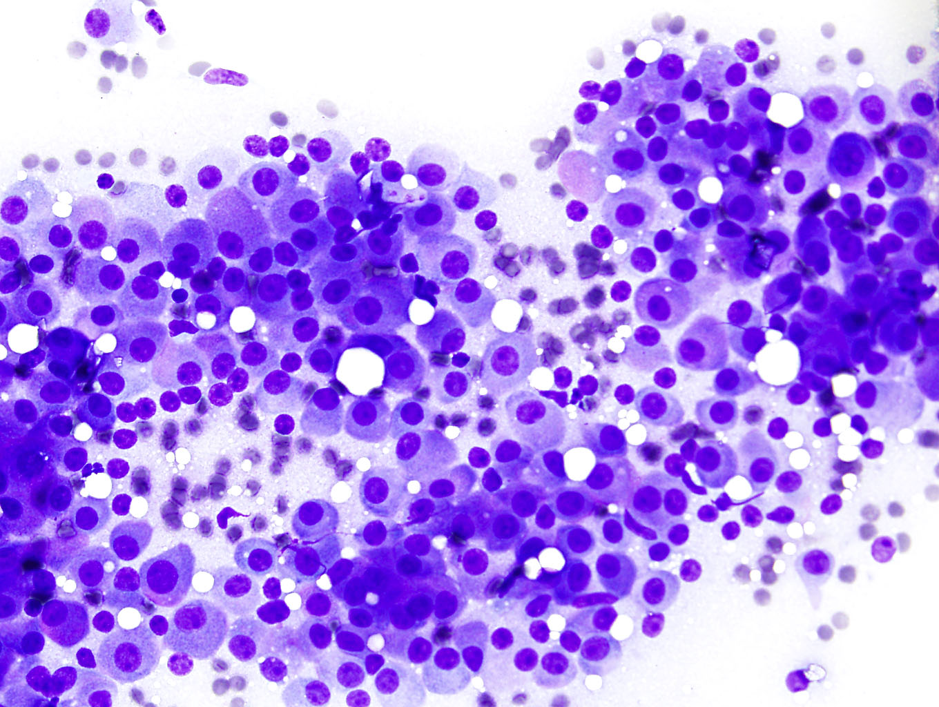 Fig. 7.2 Malignant: Acinic cell carcinoma (ACC) | University of ...