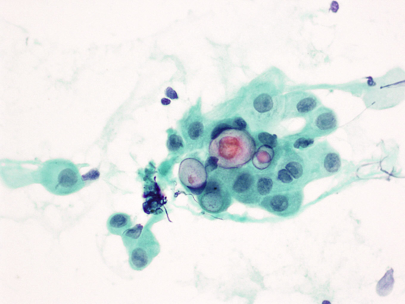 Fig. 7.27a Malignant: Mucoepidermoid Carcinoma (MEC), Low Grade ...