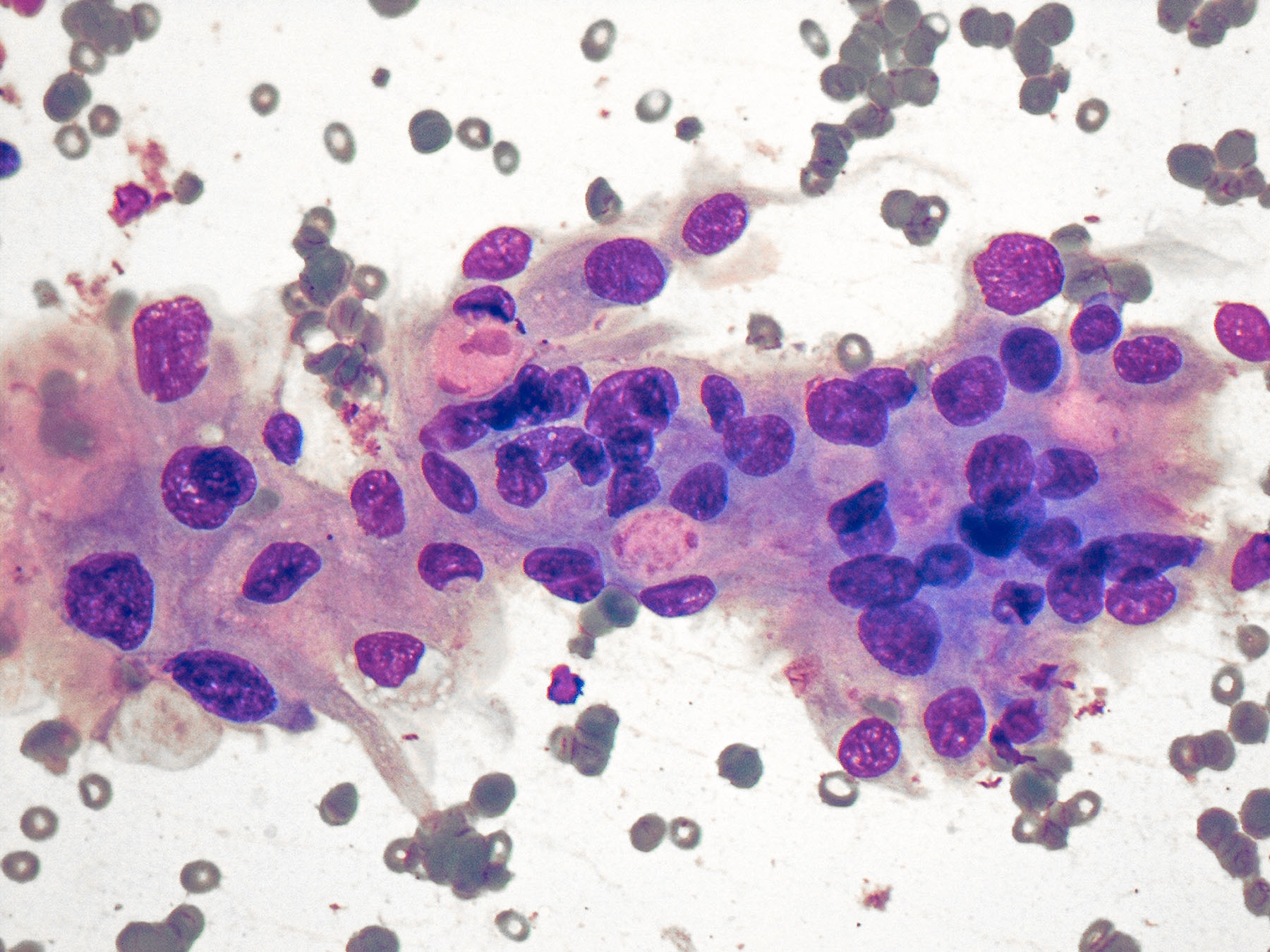 Fig. 7.29 Malignant: Mucoepidermoid Carcinoma (MEC) High grade ...
