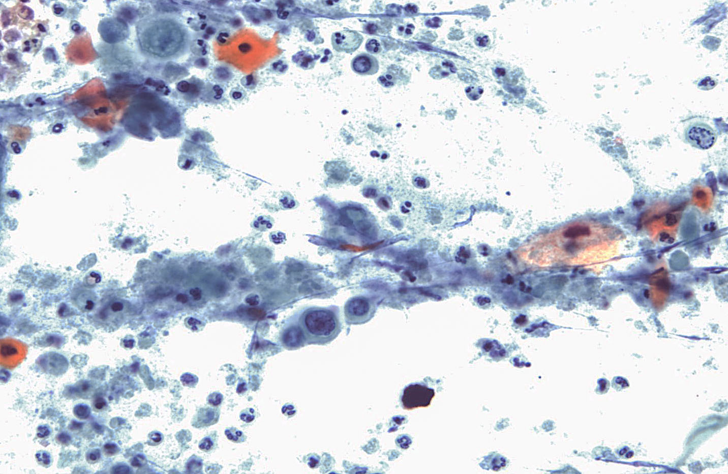 Fig. 7.45 Malignant: Squamous Cell Carcinoma: Metastatic | University ...