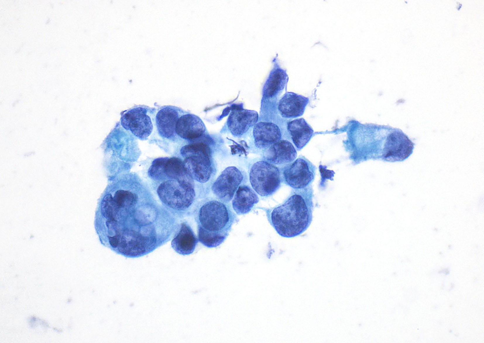 Fig. 7.6 Malignant: Acinic Cell Carcinoma (ACC) | University of ...