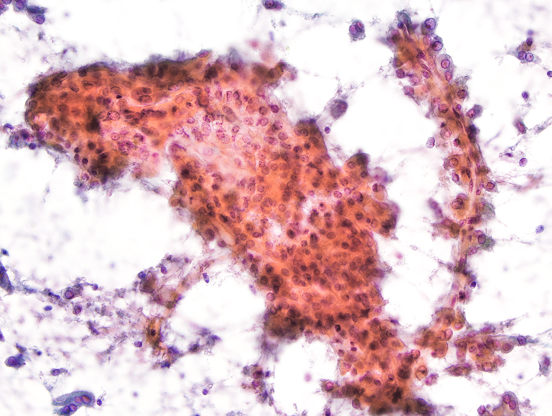 Fig. 7.7b Malignant: Secretory Carcinoma (SC) (MASC) | University of ...