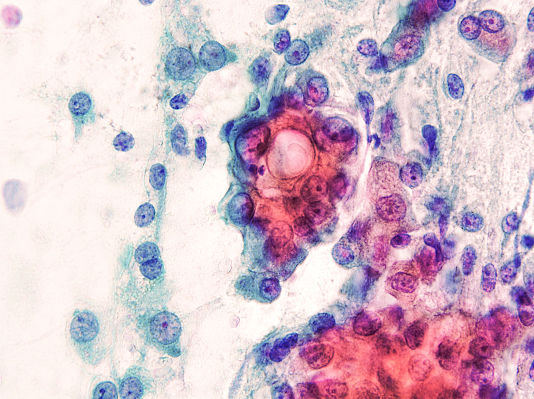 Fig. 7.7c Malignant: Secretory Carcinoma (SC) (MASC) | University of ...