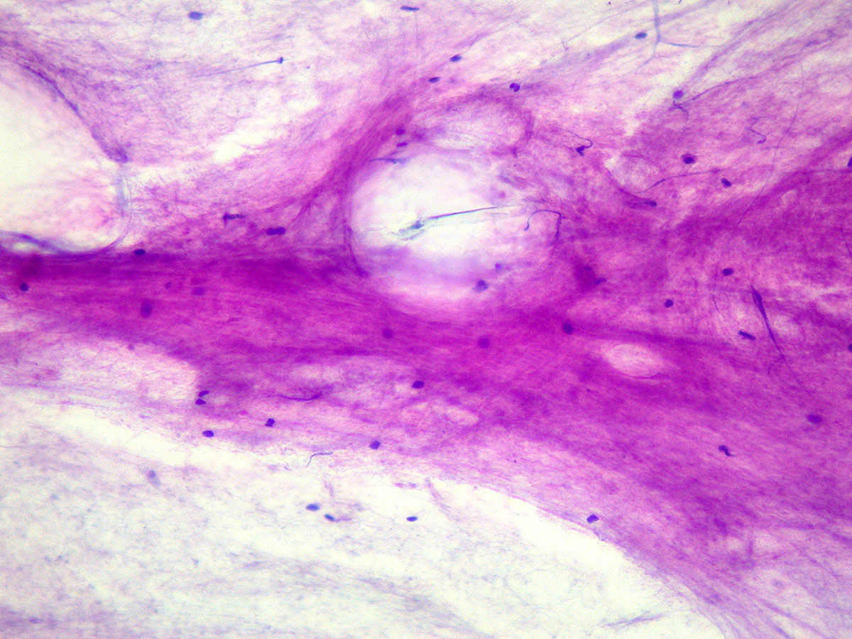 Fig. 4.7 Atypia of Undetermined Significance (AUS) | University of ...