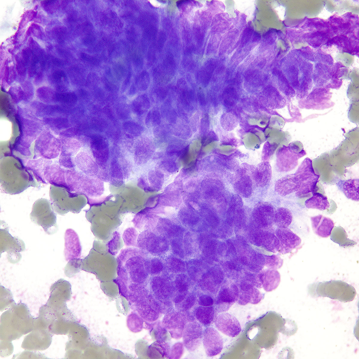 Fig. 5.16b Neoplasm: SUMP | University of Wisconsin–Madison