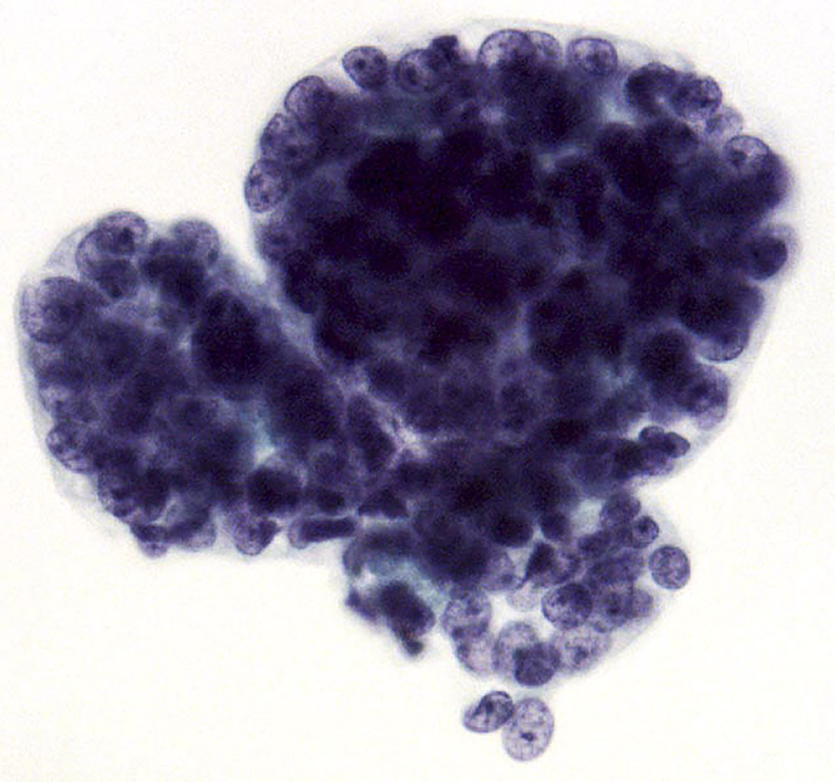 Fig. 5.17b Neoplasm: SUMP | University of Wisconsin–Madison