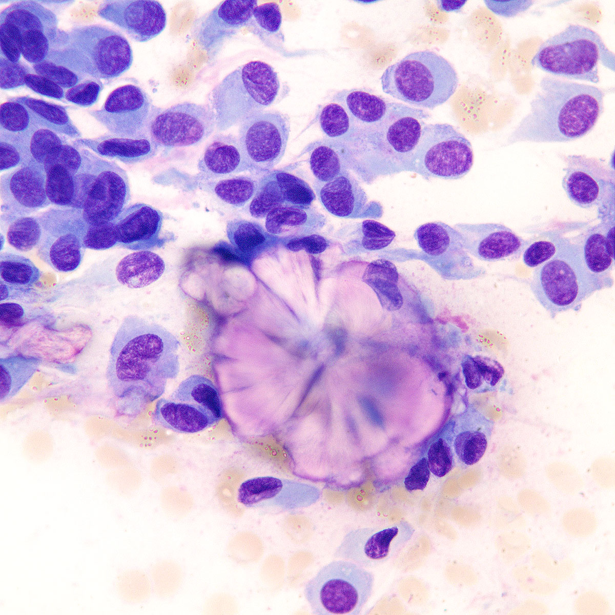 Fig. 5.19b Neoplasm: SUMP with Oncocytic Features | University of ...