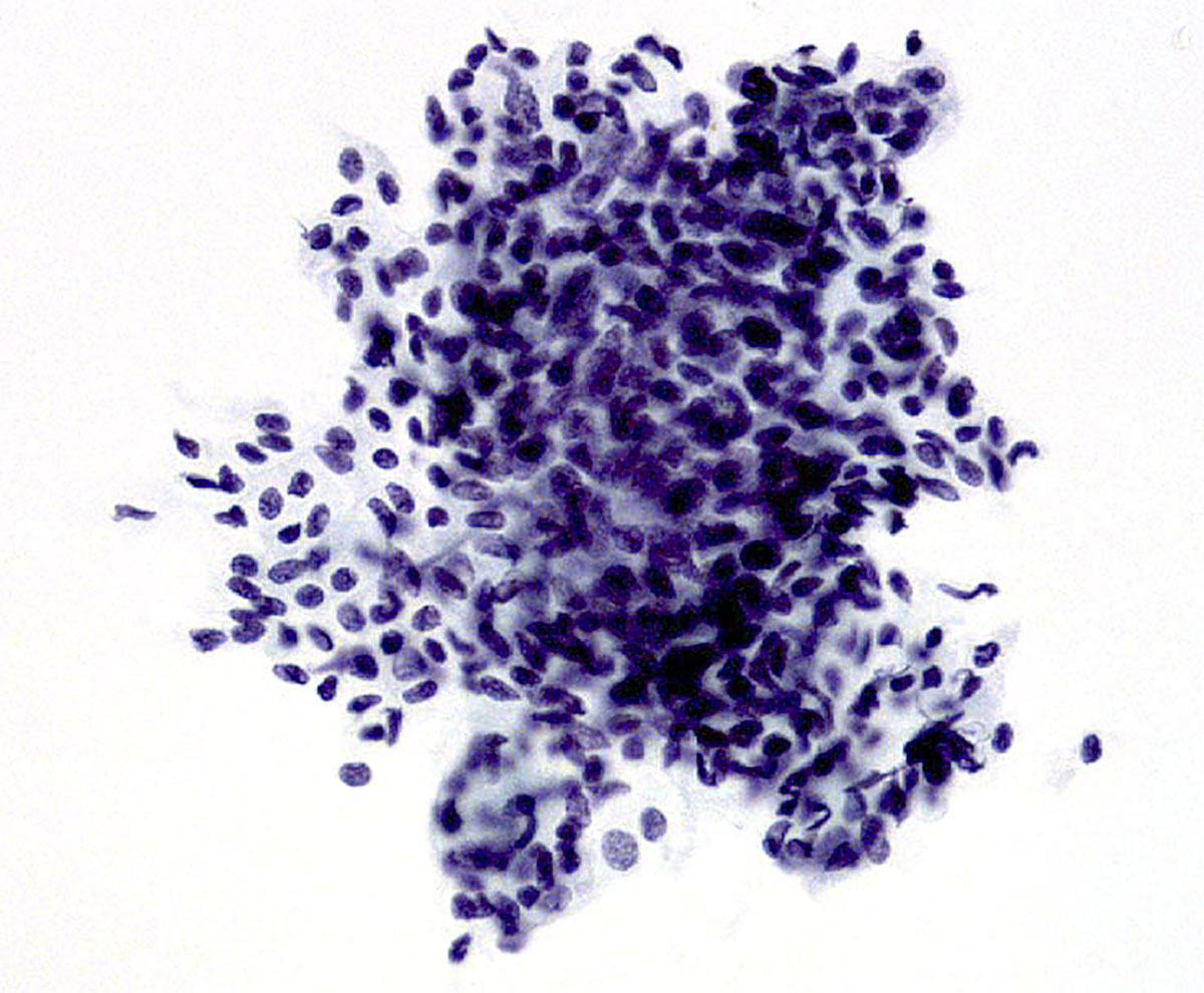 Fig. 5.2c Neoplasm: SUMP | University of Wisconsin–Madison