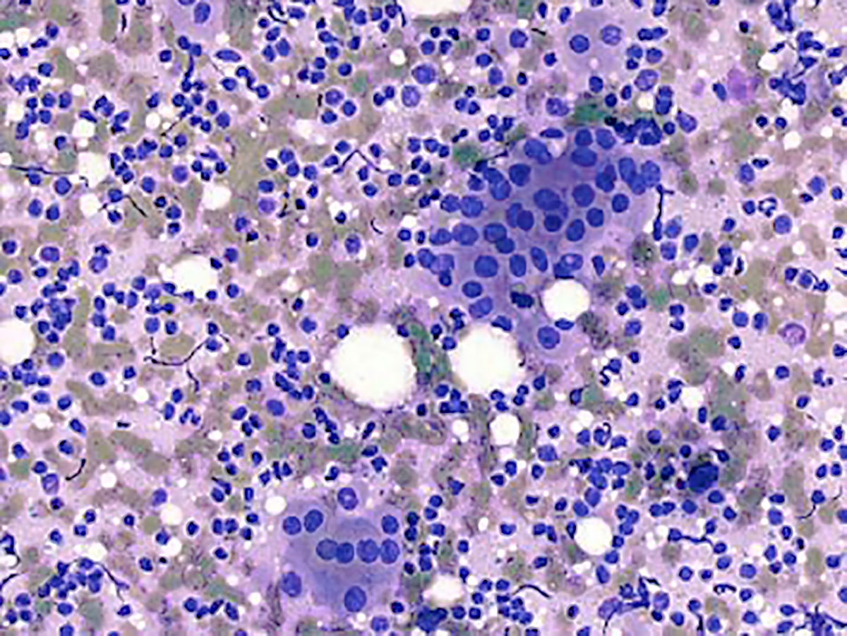 Fig. 5.9a Neoplasm: Benign: Warthin Tumor | University of Wisconsin–Madison